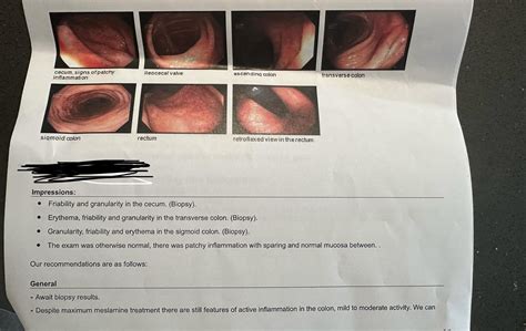 Distal Colitis To Patchy Inflammation Ribd