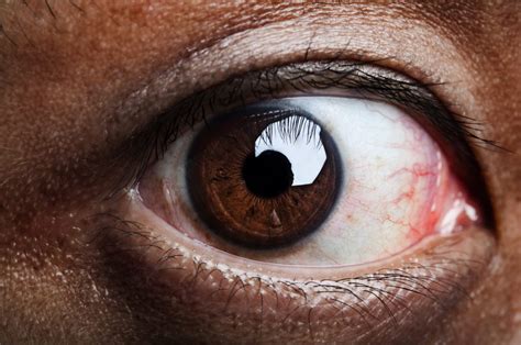 Do I Have Uveitis Or Iritis