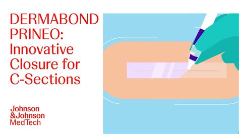 How Dermabond Prineo Skin Closure System Works On Your C Section Jandj