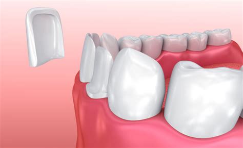 All You Need To Know About Labial Veneers The Event Chronicle