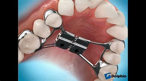 Orthodontic Expander Spacers Marpe Rapid Palatal Expander For Adults