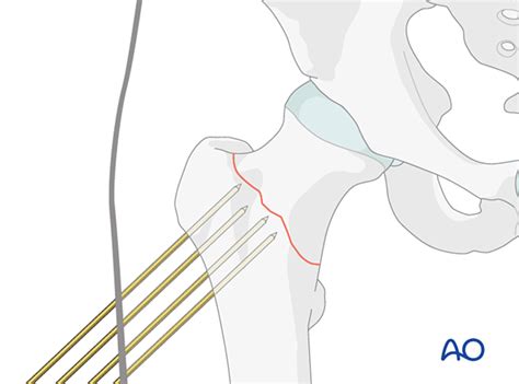 Percutaneous Reduction Techniques Femoral Neck Fractures