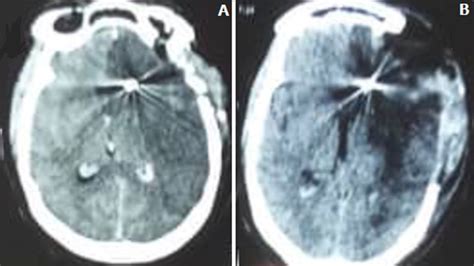 Decompressive Craniectomy Indications And Results Of 24 Cases At The