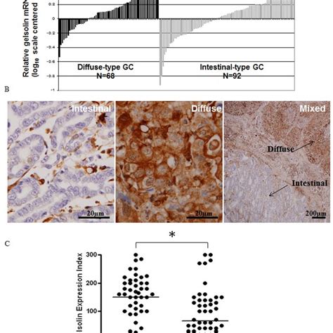 Increased Gelsolin Expression In Diffuse Type Gastric Cancer A