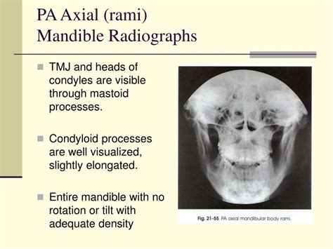 Ppt Mandible And Tmj Lecture Powerpoint Presentation Free Download