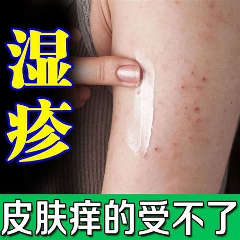 Calamine Lotion Eczema Heat Rash Skin Diseases And Prickly Heat Rash