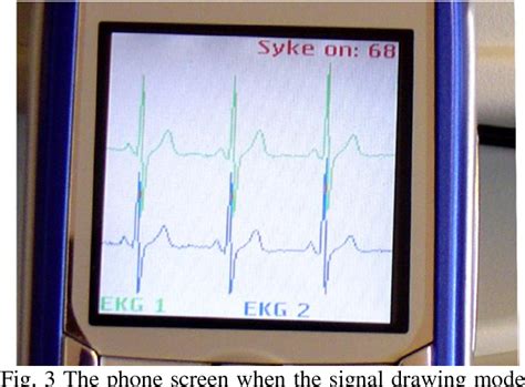 Figure 1 From Electrocardiogram Display Data Capturing And Digitization