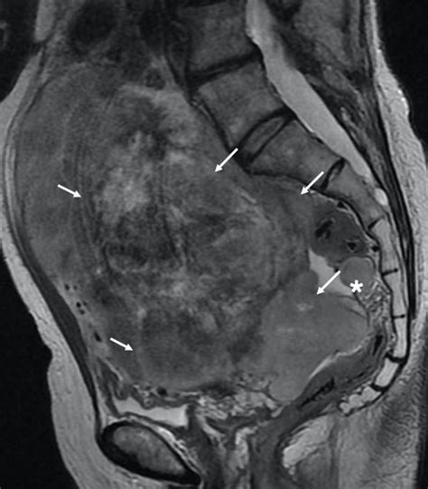 Phân Biệt Sarcoma Tử Cung Với Nhân Xơ Tử Cung Kiểm Tra Bet1t2er