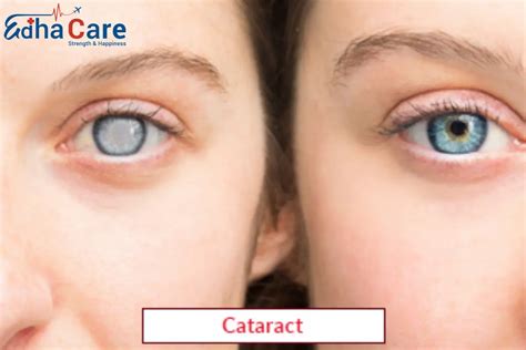 Cataract Surgery Cataract Treatment Lens Replacement Surgery