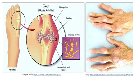 Gout Pathophysiology Of Gout Gout What Is Gout Causes Of Gout