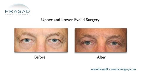 Hooded Eyelid Surgery Results And Recovery