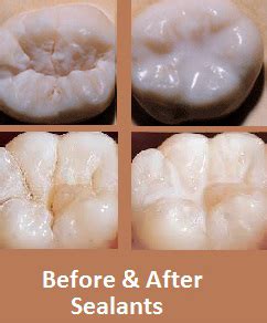 Sealants