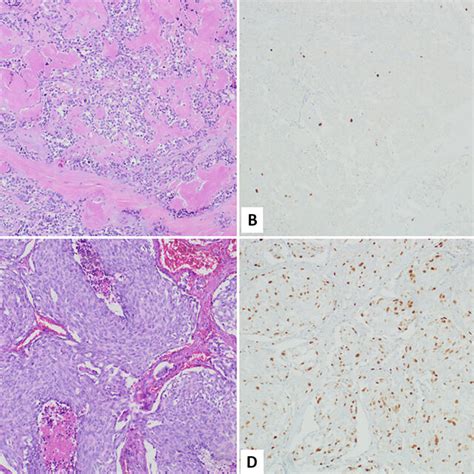 Low Grade Medullary Thyroid Carcinoma A Showing A Ki67 Proliferative Download Scientific