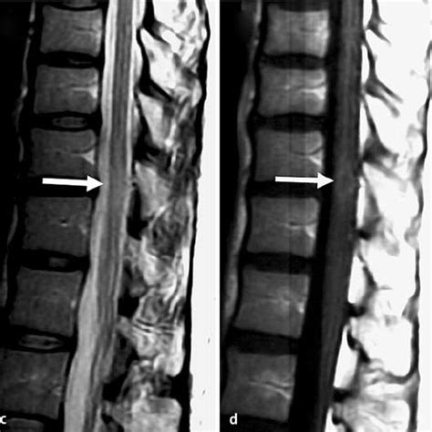 Mri Findings Of The Presented Case Bilateral Hypothalamic Lesions