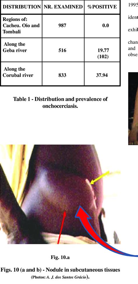 Nodule In Subcutaneous Tissues Download Scientific Diagram