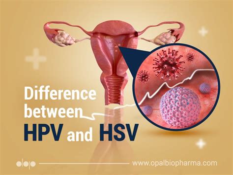 Difference Between HPV and HSV أوبال بیو فارما