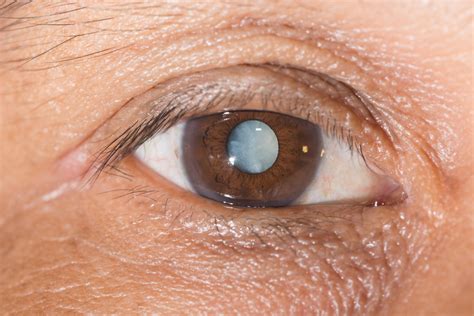 Different Types Of Cataracts Gurjeet Jutley