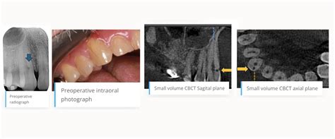 External Cervical Resorption In A Sound Tooth Endo Elements
