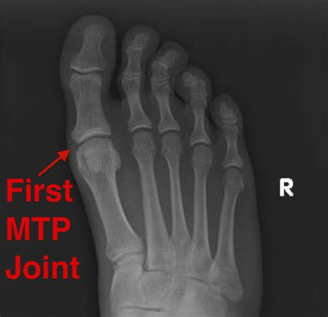 Big Toe 1st Mtp Joint Arthritis Orthopaedics 360