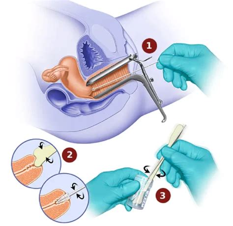 Pap Smear Test In Thane Cervical Cancer Dr Aditi Godbole
