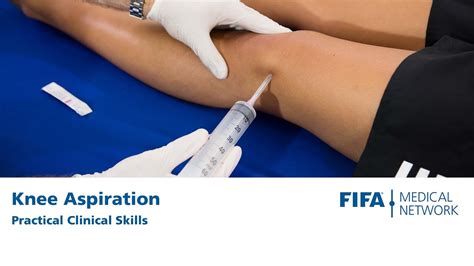 Knee Fluid Replacement