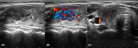 Three Views Of Lymphocytic Infiltration Lymphatic Follicles Of Download Scientific Diagram