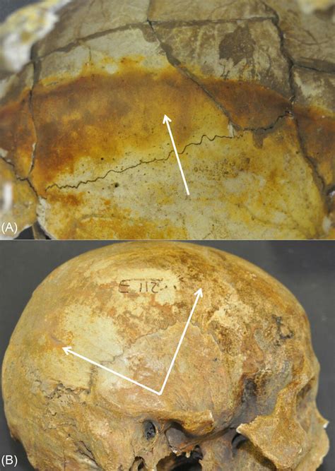 6 A Endocranial Orange Staining B Ectocranial Iron Staining