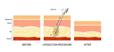 Subcutaneous Fat Surgery