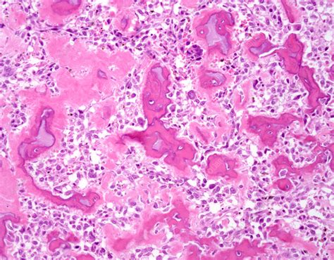 Osteoblastic Osteosarcoma Light Micrograph Stock Image C057 7543 Science Photo Library