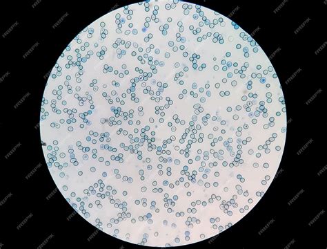 Premium Photo Abnormal Reticulocyte Count