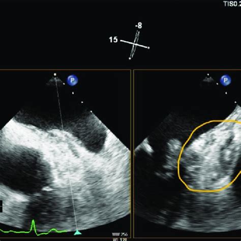 Transoesophageal Echocardiogram Showing Aortic Root Abscess Download Scientific Diagram