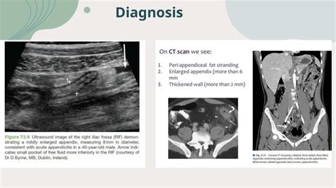 Appendix And Appendicitis Overview Presentation Pptx