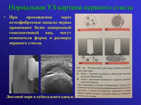 Ультразвуковое исследование периферических нервов - презентация онлайн