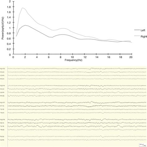 Quantitative Eeg Analysis Basics Neupsy Key
