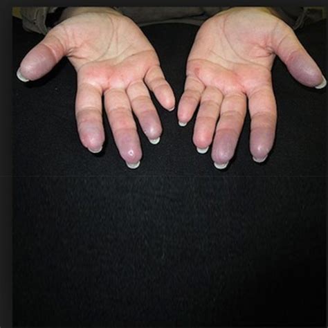 What Is Vasculitis Symptoms And Treatment In Australia