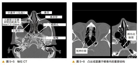 【推荐】颅底ct及鼻窦轴冠矢解剖图 脑医汇