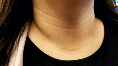 Neck Rings Skin