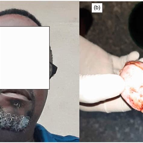 A Preoperative Photograph Showing Temporal Swelling B