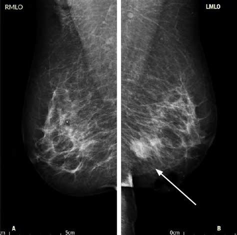 Mammogram Mlo View Soft Tissue Density Lesion In The Lower Medial