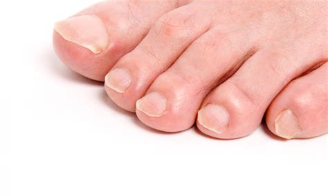 What Is Out Toeing Causes Symptoms And Best Treatment Bilt Labs