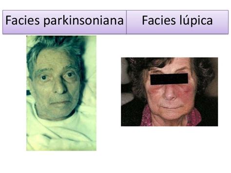 Facies Parkinsoniana