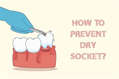 What Is Dry Socket M Dental Clinic In Vancouver