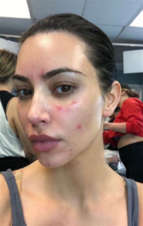 Kim Kardashian Opens Up About Life With Psoriasis In Honest Open Letter