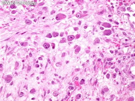 Proliferative Fasciitis Differential