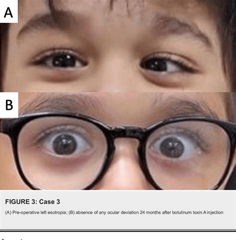 Pdf Cyclic Esotropia Managed With Botulinum A Toxin Injections A