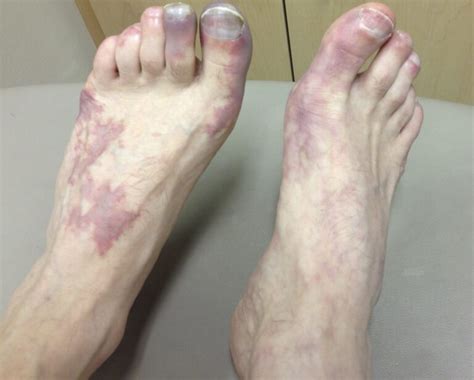 Angulated Retiform Purpura RheumExam Atlas