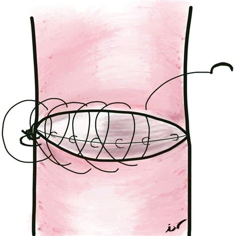open loop technique continuous suture of the upper face of the vessel