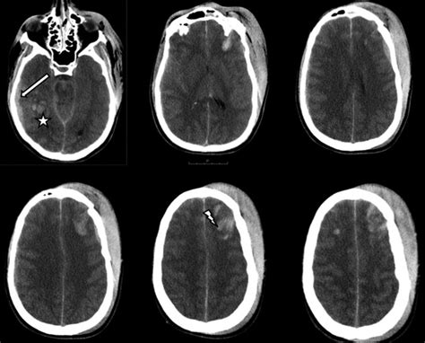 Preoperative Head Computed Tomography Ct Scan This Axial Download Scientific Diagram