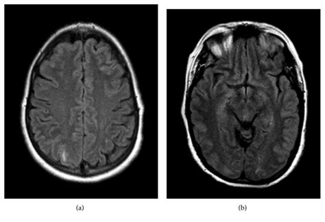 Posterior Reversible Encephalopathy Syndrome In 54 Year Old