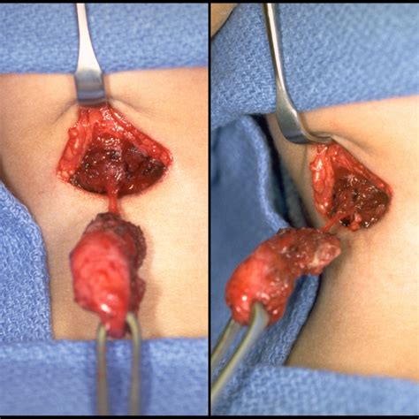 Thyroglossal Duct Cyst Jaypeedigital Ebook Reader